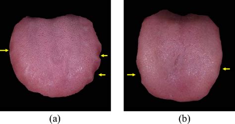 Figure 4 From Tooth Marked Tongue Recognition Using Multiple Instance Learning And Cnn Features