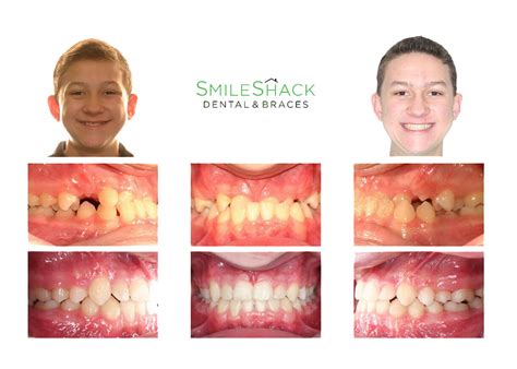 Before And After Smile Gallery Smileshack Dental And Braces