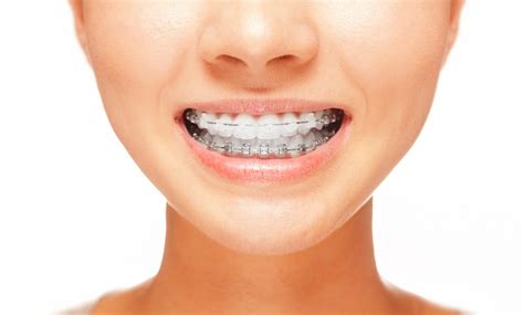 5 Tips For Keeping Your Mouth Healthy When Wearing Braces