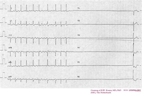 Filesss Ecg 001 Ecgpedia