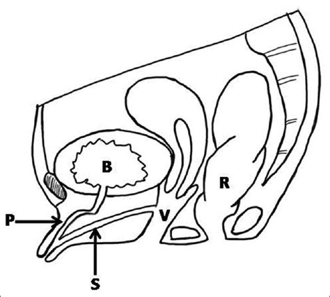 Female Pseudohermaphroditism With Urethral Duplication A Delayed
