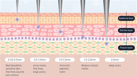 The Ideal Microneedling Depth For Deep Acne Scars Professional