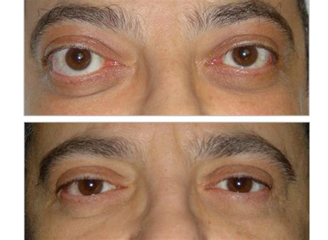 Thyroid Eye Disease Clinical Features Imaging And Surgery The Dh