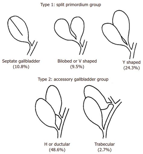 Duplicated Gallbladder With Obstructive Jaundice A Case Report With Video