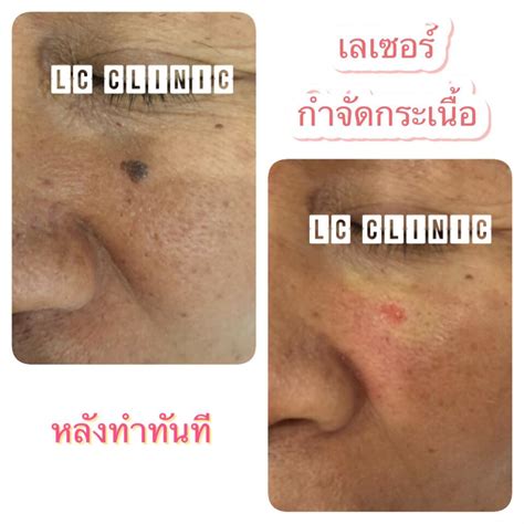 Lc Clinic รีวิว เลเซอร์กำจัดกระเนื้อ