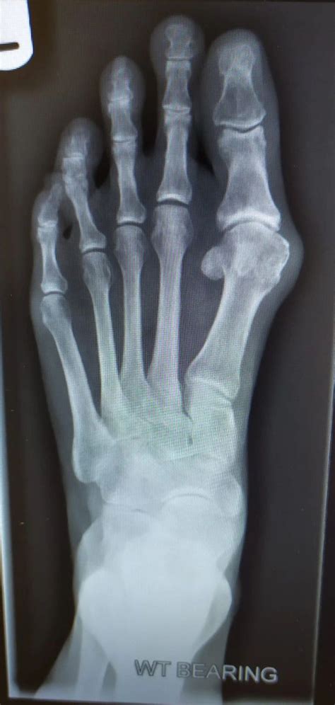 Madhu Tiruveedhula On Linkedin Silastic Mtpj Replacement Why Fuse When