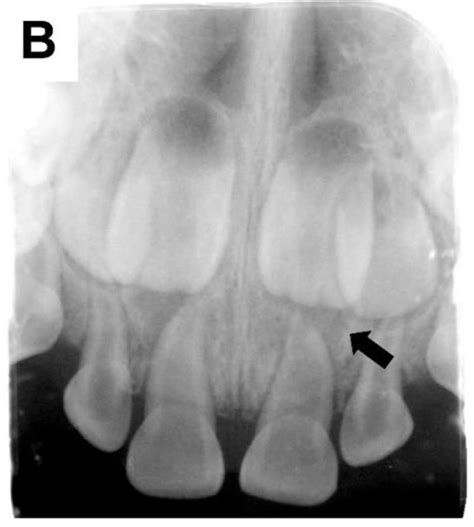 Hypophosphatemia Focus Dentistry