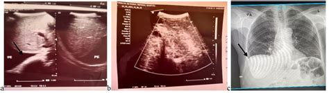 A B Trans Abdominal Ultra Sonogram Shows A 30 × 25 × 20 Cm Sized Well