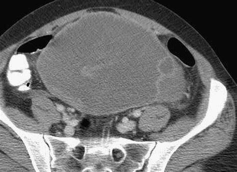 The Appendix On Ct Clinical Radiology