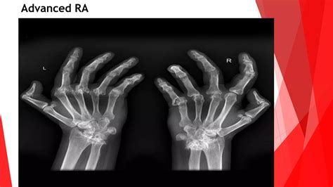 Differential Diagnosis Of Musculoskeletal Involvement In Rheumatoid