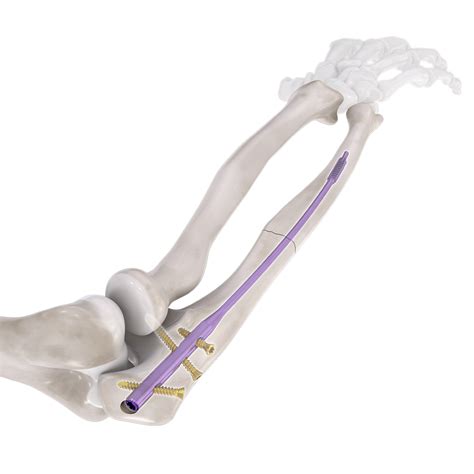 Ulna Geometrical Adaptation In Ulna And Radius Of Cerebral Palsy