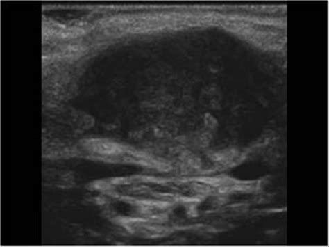 Head And Neck 4 3 Salivary Glands Case 4 3 5 Malignant Salivary Gland Tumors Ultrasound Cases