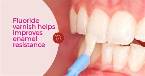 What Is Fluoride Varnish And What Makes It So Important Lotus