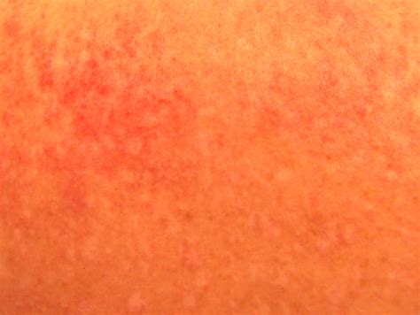 Dermatomyositis Pictures Rash Symptoms Causes Treatment
