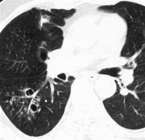 000 Tree In Bud Sign The Common Vein
