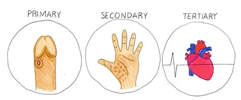 Explain The Different Stages Of Syphilis