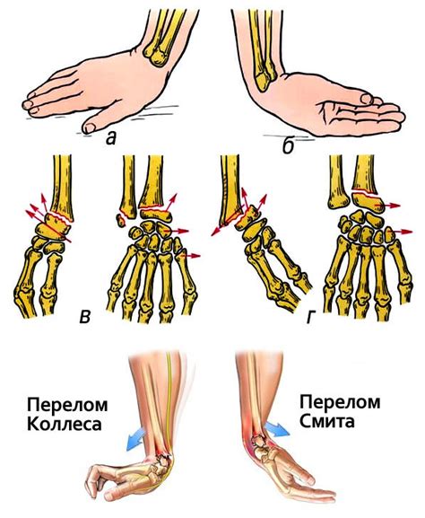 Перелом кисти руки: первая помощь, как понять что травма, симптомы и ...