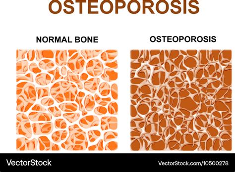 Osteoporosis Bone Royalty Free Vector Image Vectorstock