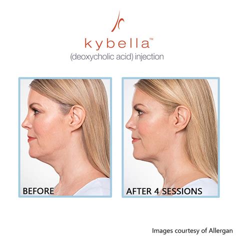 Is Kybella A Good Procedure For Double Chin Treatment