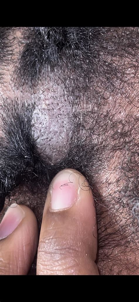 Patch On Scalp Rdermatologyquestions