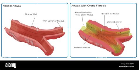 Illustration Comparing A Normal Bronchiole At Left To A Blocked Bronchial Resulting In Cystic