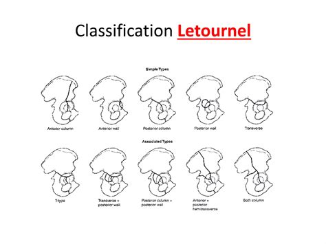 Hip Periprosthetic Fracture Pptx