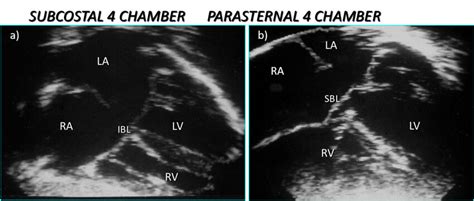 Echocardiography Sections From A Partial Atrioventricular Septal Defect