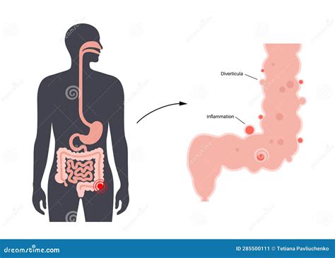Diverticulitis En Diverticulose Vector Illustratie Illustration Of