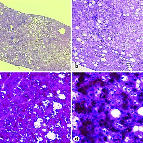Electron Microscopy From Patient Liver Biopsy Demonstrating Glycogen