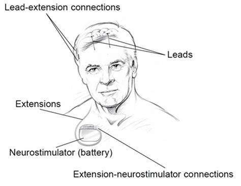 Medtronic DBS System For Epilepsy A SAGES Technology And Value Assessment