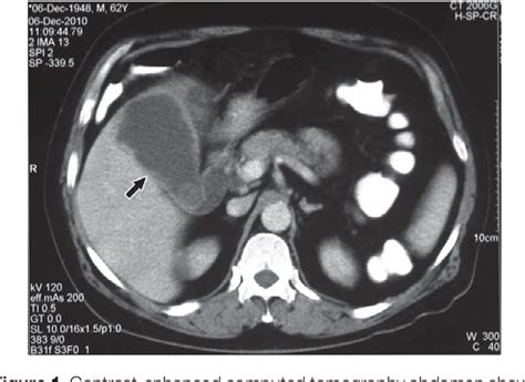 Figure 1 From Spontaneous Perforation Of Gallbladder With Intrahepatic