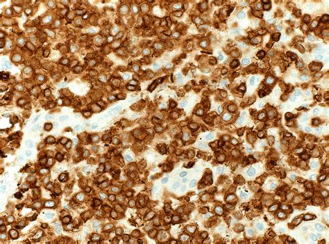 Pathology Outlines Cd3