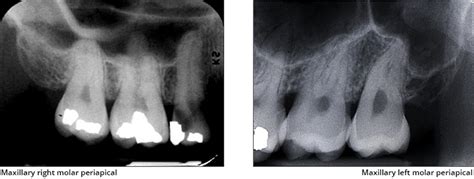 Zygomatic Process Radiograph