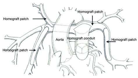 Illustration Demonstrating Complete Repair Of Pa Vsdmapcas Including Download Scientific Illustration Demonstrating Complete Repair Of Pa Vsdmapcas Including Download Scientific
