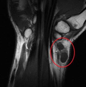 Ganglion Cysts Of The Hand And Wrist Musculoskeletal Medicine For