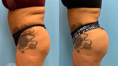 Brazilian Butt Lift Before And After Photo Gallery Tyaqzg