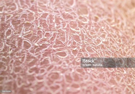 태양 노출 후 크고 작은 균열과 죽은 벗겨진 비늘로 덮인 건조한 건강에 해로운 피부 질감의 배경 분홍에 대한 스톡 사진 및 기타