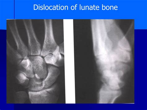 Ppt Wrist And Hand Powerpoint Presentation Free Download Id9697802