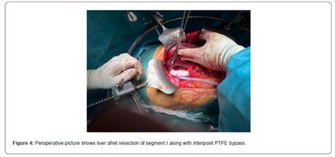 Perioperative Management Of Patient With Ivc Leiomyosarcoma Resection