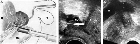 Figure 1 From A Comparison Of Prilocaine Vs Prilocaine Bupivacaine In Periprostatic Block In