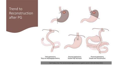 Proximal Gastrectomy For Early Gastric Cancer Pptx