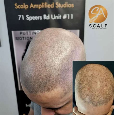 Scalp Micropigmentation Before And After Examples Scalp Amplified Scalp Micropigmentation Before And After Examples Scalp Amplified