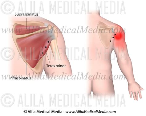 Supraspinatus Trigger Point