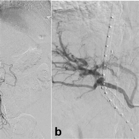 Digital Subtraction Angiogram Images From The Procedure Show A Widely Download Scientific