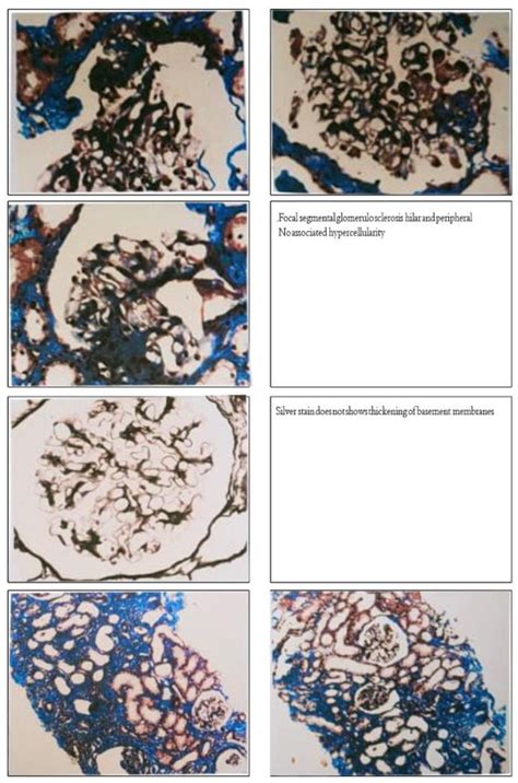 Figure 1 From Development Of Focal Segmental Glomerulosclerosis 4 Years Following Direct Acting