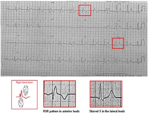 Right Bundle Branch Block Deranged Physiology