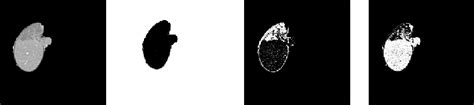Github Zahrakhoshdel Automated Liver Tumor Detection