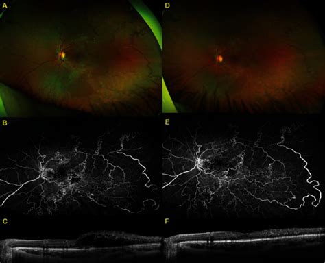 Five Year Follow Up Of Repeated Intravitreal Bevacizumab For Macular