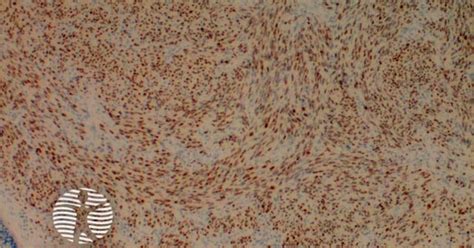 Kaposi Sarcoma Pathology Hhv 8 Stain Image