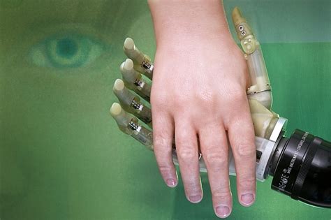 I Limb Bionic Hand